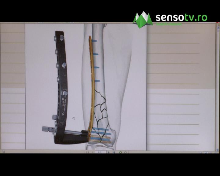 Probleme moderne de osteosinteza - Sensosanatate